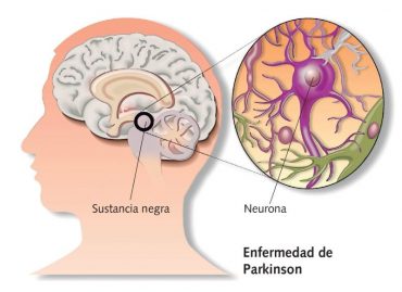 Masked Faces in Parkinson Disease – Fashion Digger